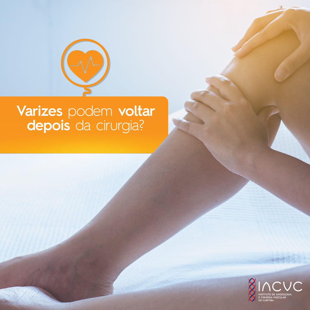 Varizes podem voltar depois da cirurgia? – IACVC